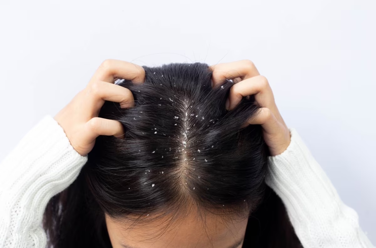 All you need to know about Dandruff Causes and Treatment